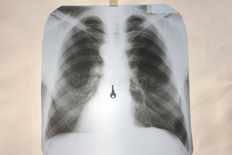 Chest, Lung X-ray, Medical Health Examination, Key Inside Stock Image ...