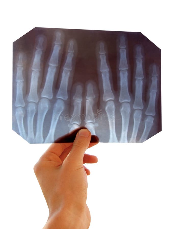 Roentgenogram (X-ray) stock photo. Image of medicine, phalanx - 935298