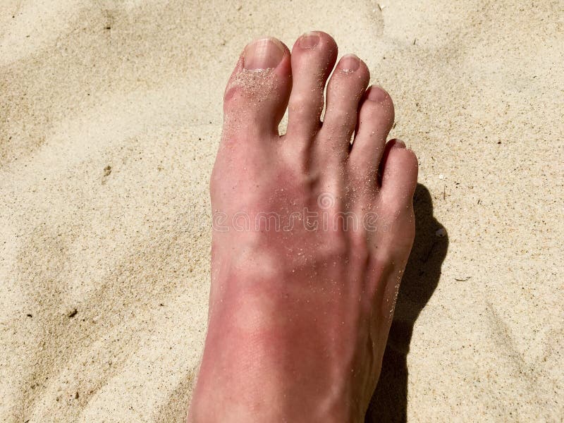 imágenes comunes del Piel De La Quemadura Del Pie - los derechos de la ...