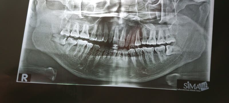 Rongent Photo of Wisdom Teeth Stock Image - Image of statue, glass ...