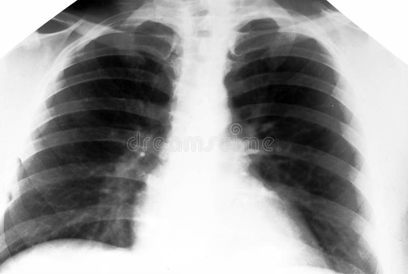 Rontgen picture stock photo. Image of chest, film, medical - 11060650