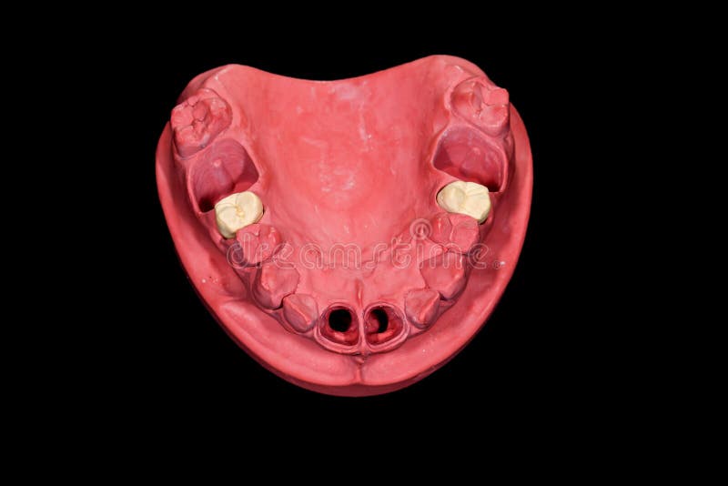 Rood gipsmodel stock foto. Image of kronen, gezondheid - 48027100