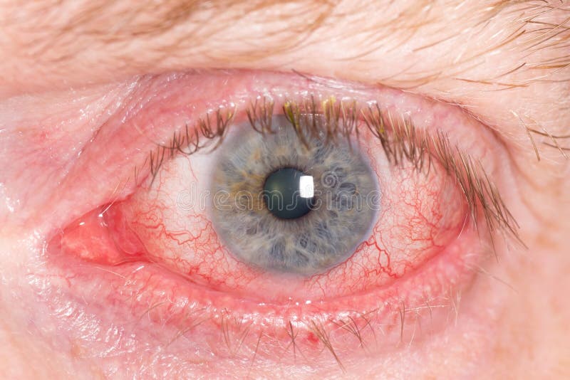 Geïrriteerd Rood Bloeddoorlopen Oog Stock Afbeelding - Image of ...