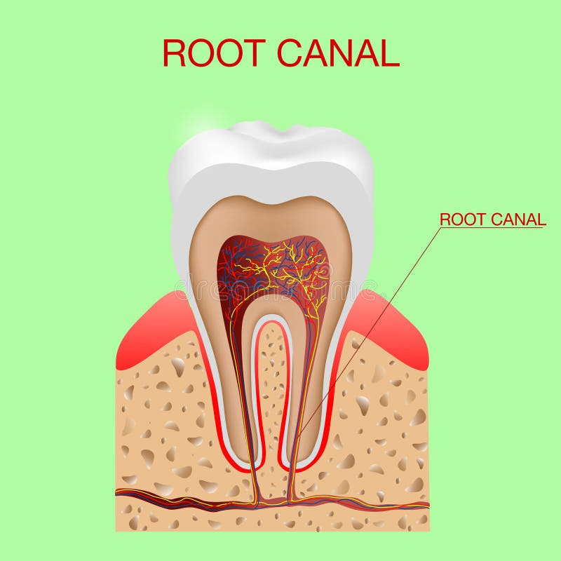 Root Canal. Dental Infographic. the Structure Inside and the Tooth ...