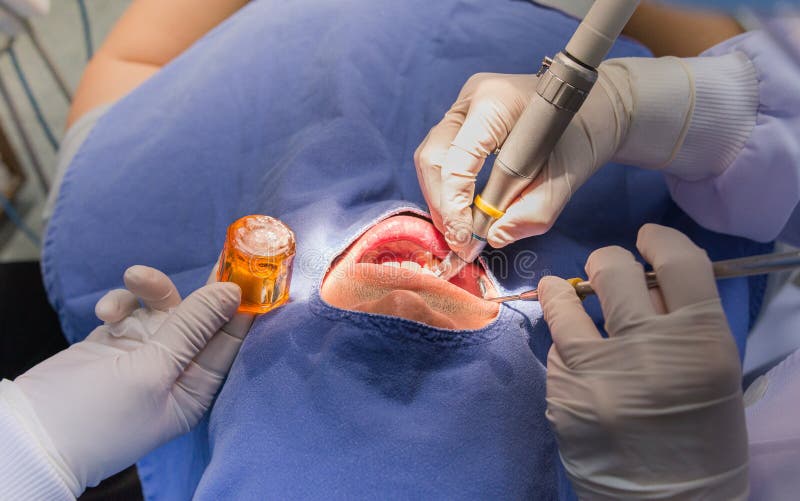 Root canal surgery stock photo. Image of pain, abscess - 94652018