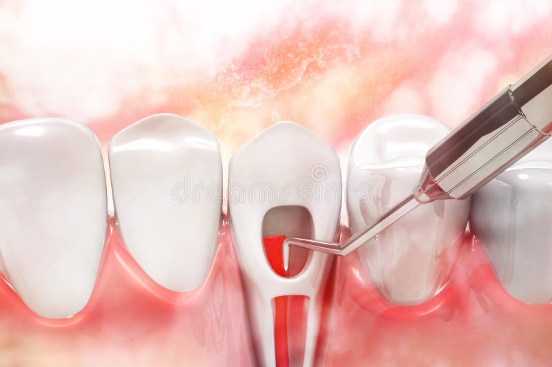 Root Canal Treatment Process Stock Illustration - Illustration of ...