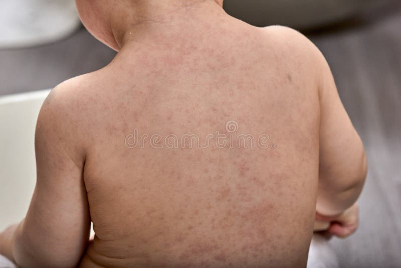 Roseola Rash a Viral Rash on the Skin of a Child Stock Photo - Image of ...