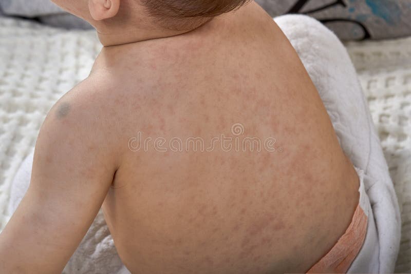 Roseola Rash a Viral Rash on the Skin of a Child Stock Photo - Image of ...