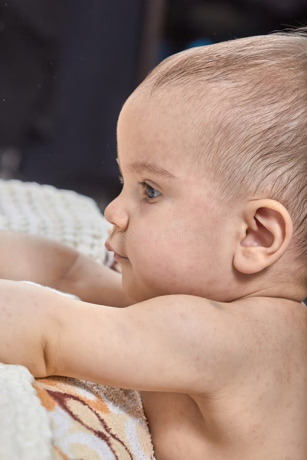 Roseola Rash a Viral Rash on the Skin of a Child Stock Photo - Image of ...