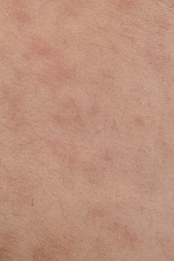 Roseola Rash a Viral Rash on the Skin of a Child Stock Photo - Image of ...