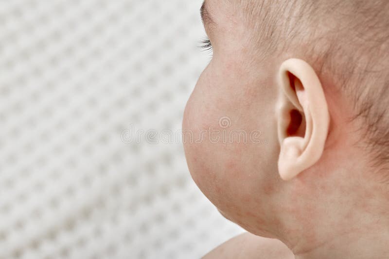 Roseola Rash a Viral Rash on the Skin of a Child Stock Photo - Image of ...