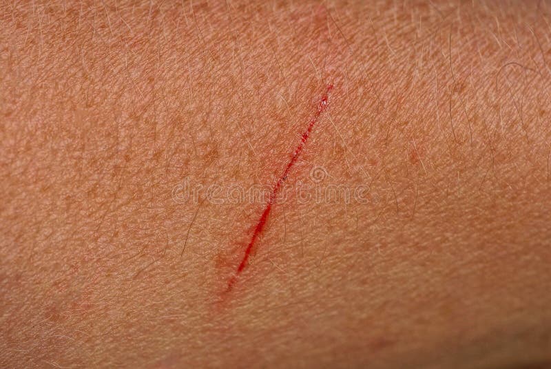 Roter Langer Geschnittener Kratzer Die Haut Der Hand Stockfoto - Bild ...