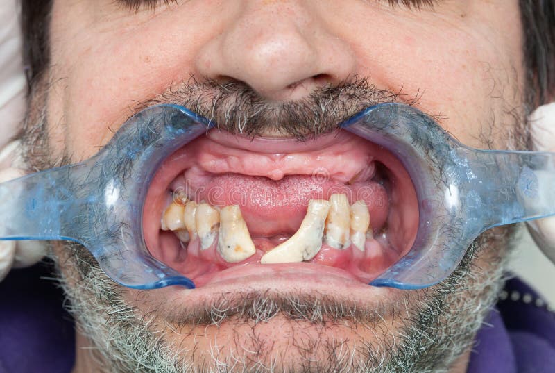 Rotten Teeth during Inspection with Retractor for Dental Implant Design ...