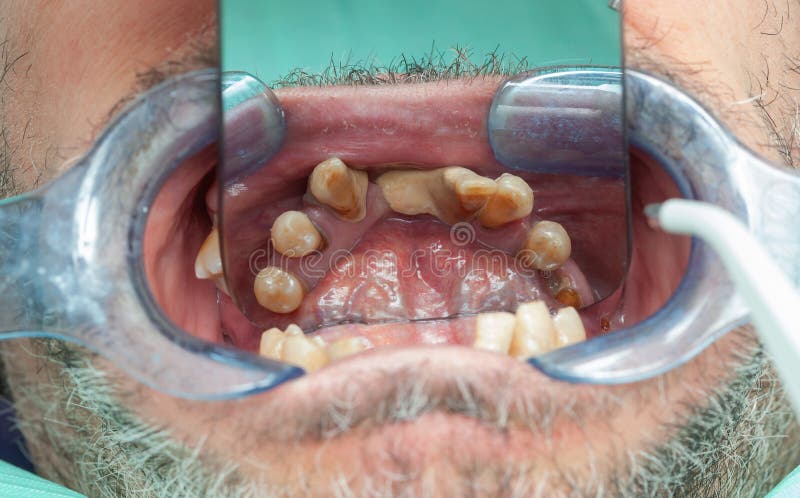 Rotten Teeth during Inspection with Retractor for Dental Implant Design ...
