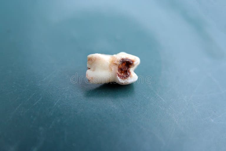Rotten Tooth. Bad Tooth. Extracted Rotten Tooth Stock Photo - Image of ...