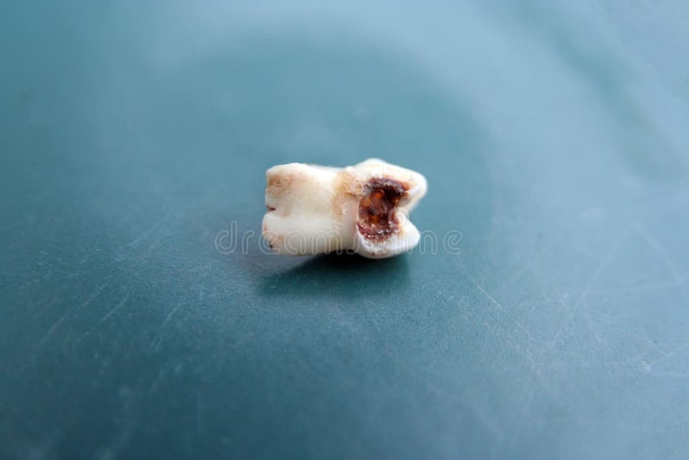Rotten Tooth. Bad Tooth. Extracted Rotten Tooth Stock Photo - Image of ...