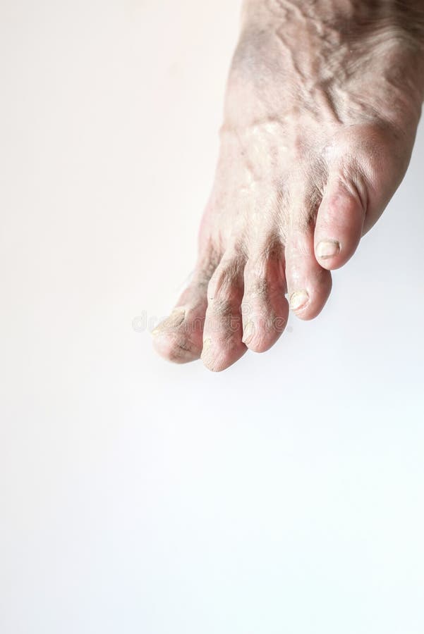 Rough Feet of an Elderly Man on a White Background Stock Photo - Image ...