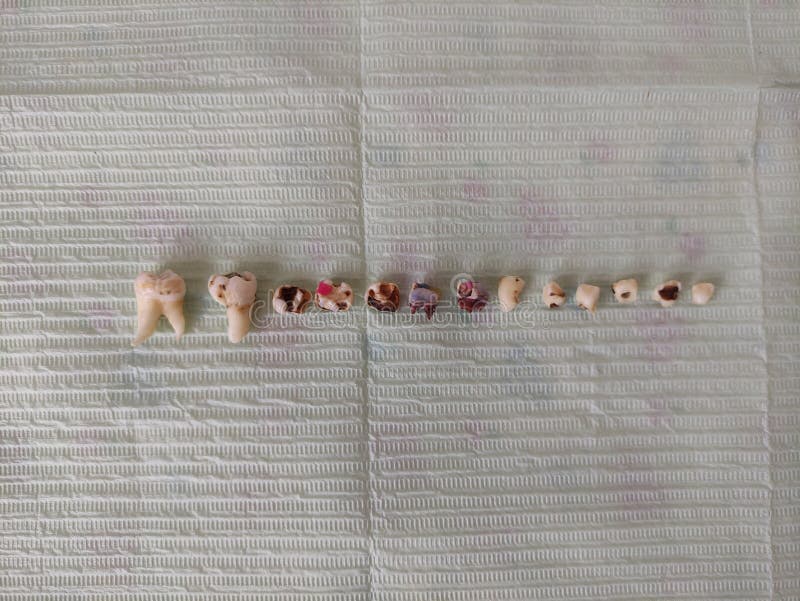Row of Extracted Teeth on a Napkin Stock Photo - Image of aged, human ...