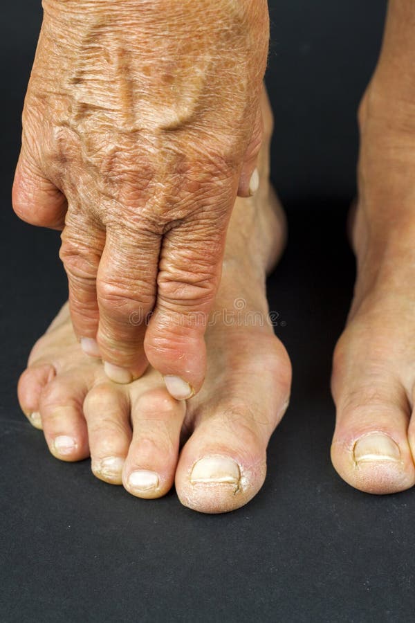 Rrheumatoid Arthritis Hand and Toe Deformities Stock Image - Image of ...