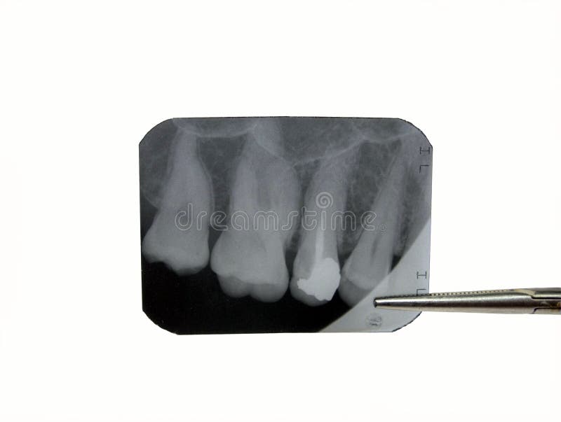 Rtg stock photo. Image of patient, skiagraph, mouth, skeleton - 14857228