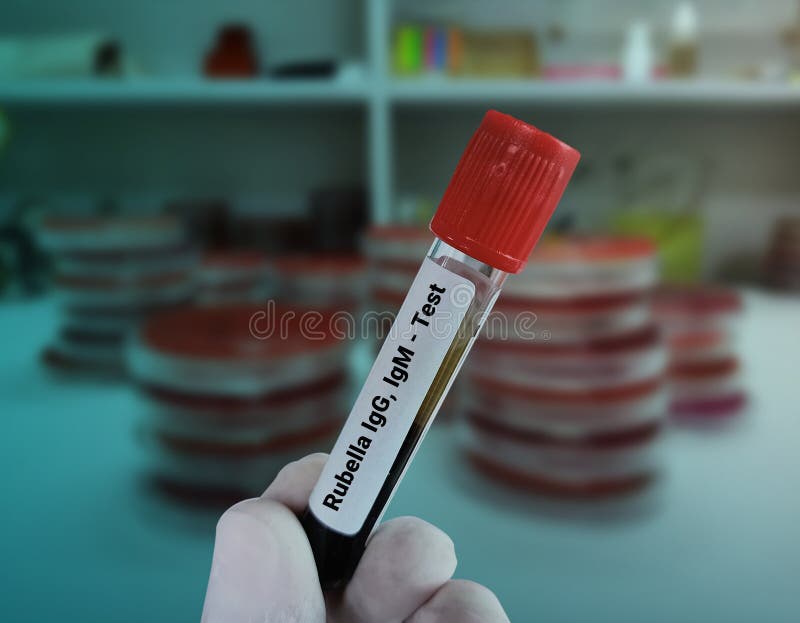 Rubella Igg Igm Test Stock Photos - Free & Royalty-Free Stock Photos ...