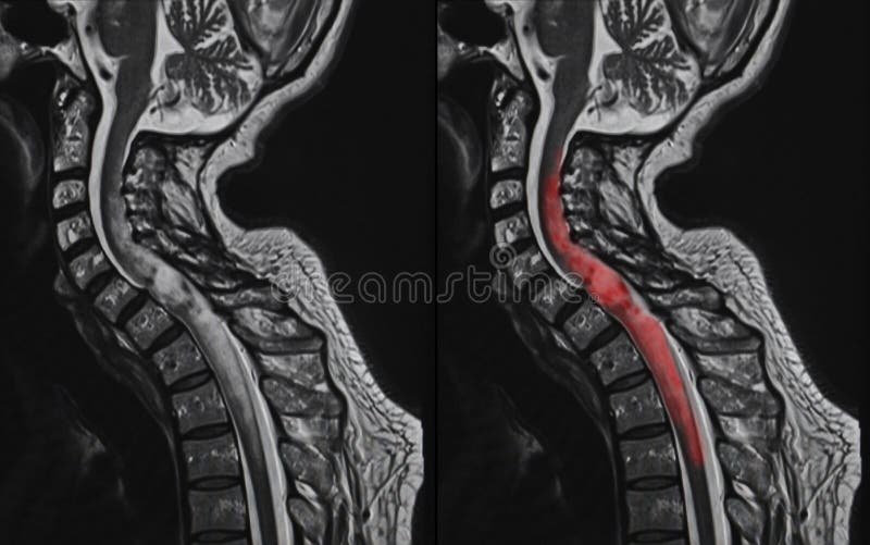 Ruggemergtumor, MRI stock afbeelding. Image of beelden - 64167835