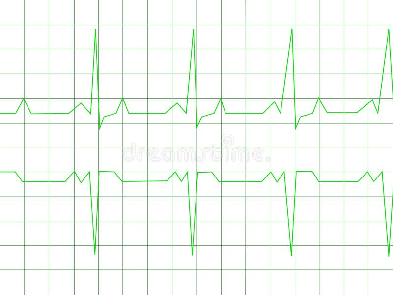 Bande D'ECG Avec La Tachycardie Ventriculaire Paroxysmale Image stock ...