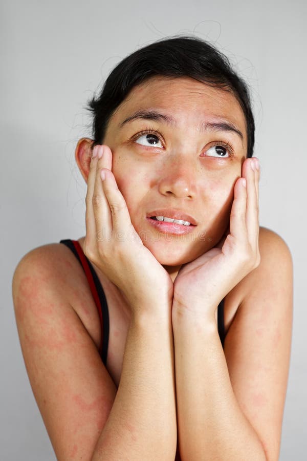 Sad woman with skin rash stock image. Image of health - 19547013