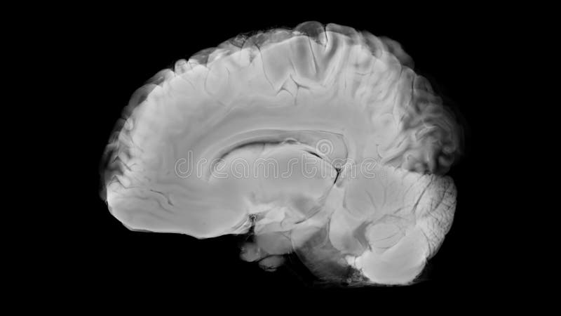 Sagittal Cross-Section of Human Brain with Ischemic Stroke on ...