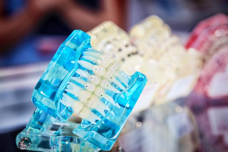 Orthodontic Braces on Model Stock Photo - Image of instrument, care ...
