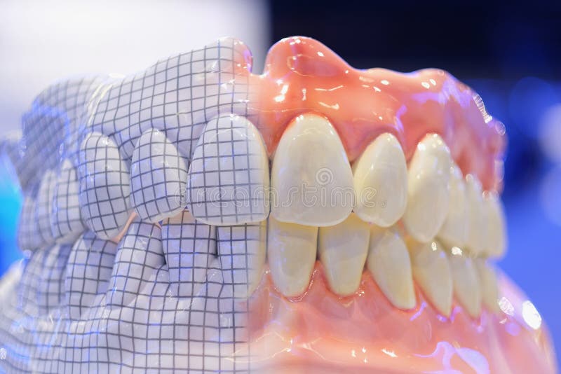 Samples of Removable Total Prostheses Stock Image - Image of prostheses ...