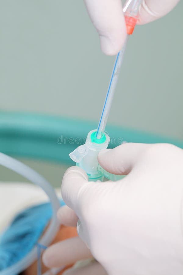 Tubal Ligation or Surgical Procedure Tubectomy in Operative Gynecology ...