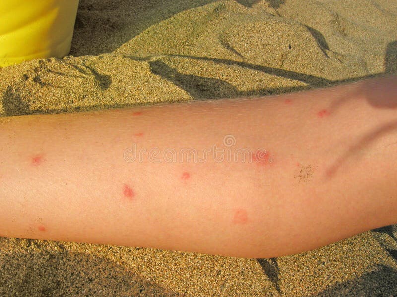 Sandy Arm of a Boy with 11 Mosquito Bites Stock Photo - Image of dengue ...