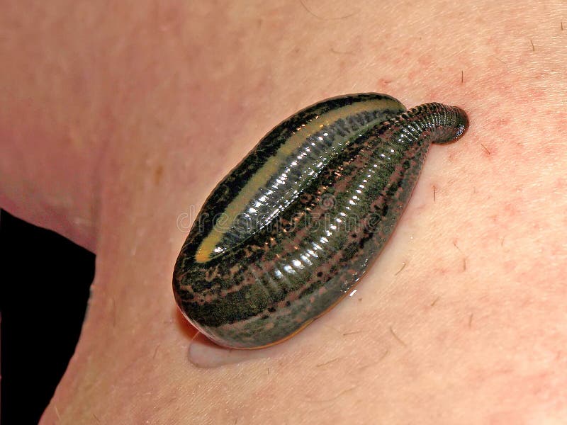 Sangsue Sur La Peau Humaine Image stock - Image du vieux, guérisseur ...