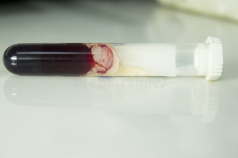 Coagulo di sangue immagine stock. Immagine di ricerca - 64291691