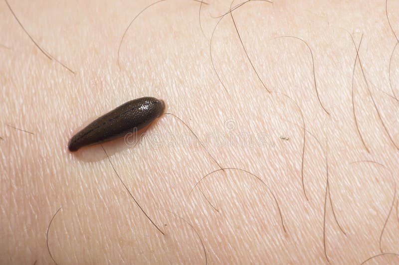 Sanguessuga na pele humana foto de stock. Imagem de corrediça - 33736524