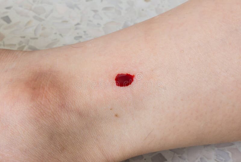 Sanguinando Dalla Ferita Della Pelle Immagine Stock - Immagine di ...