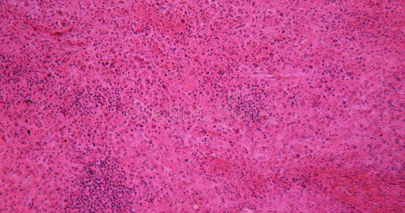 Sarcoma of the Lymphatic Gland Diseased Stock Video - Video of tumor ...