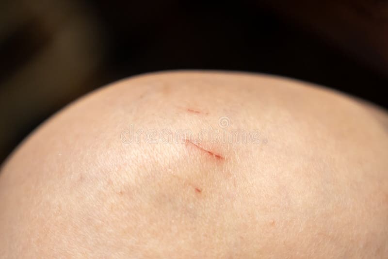 A Bleeding Wound on a Broken Skin Stock Image - Image of scab ...