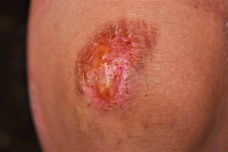 Scab on Knee with Fluid and Pus Stock Photo - Image of infected, knee ...