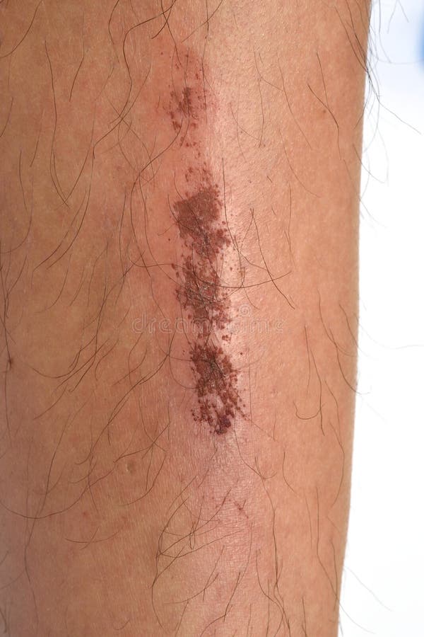 Scab leg stock image. Image of danger, health, closeup - 79487337