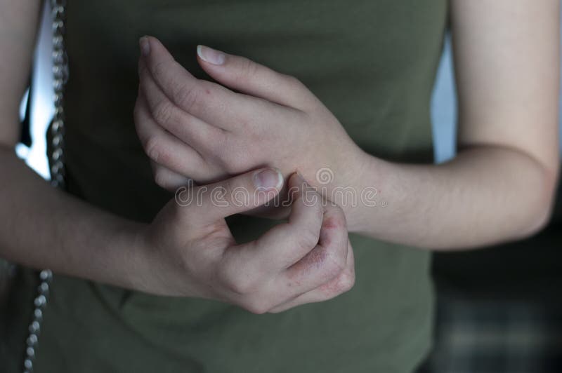 Scabies in Hands. Allergy in Fingers Stock Photo - Image of care ...