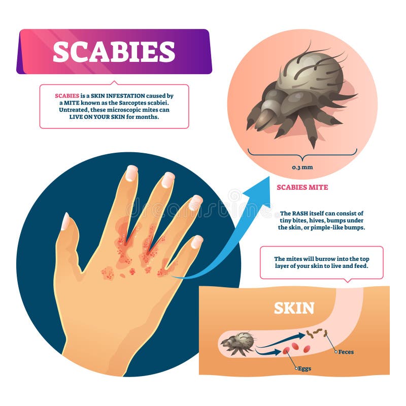 Infected Scabies Stock Illustrations – 11 Infected Scabies Stock ...