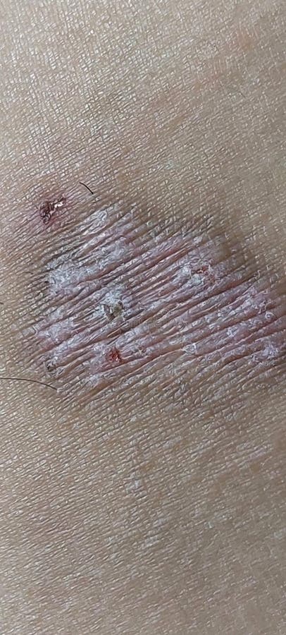 Scabs, Ringworm, Fungus on a Person& X27;s Leg Stock Photo - Image of ...