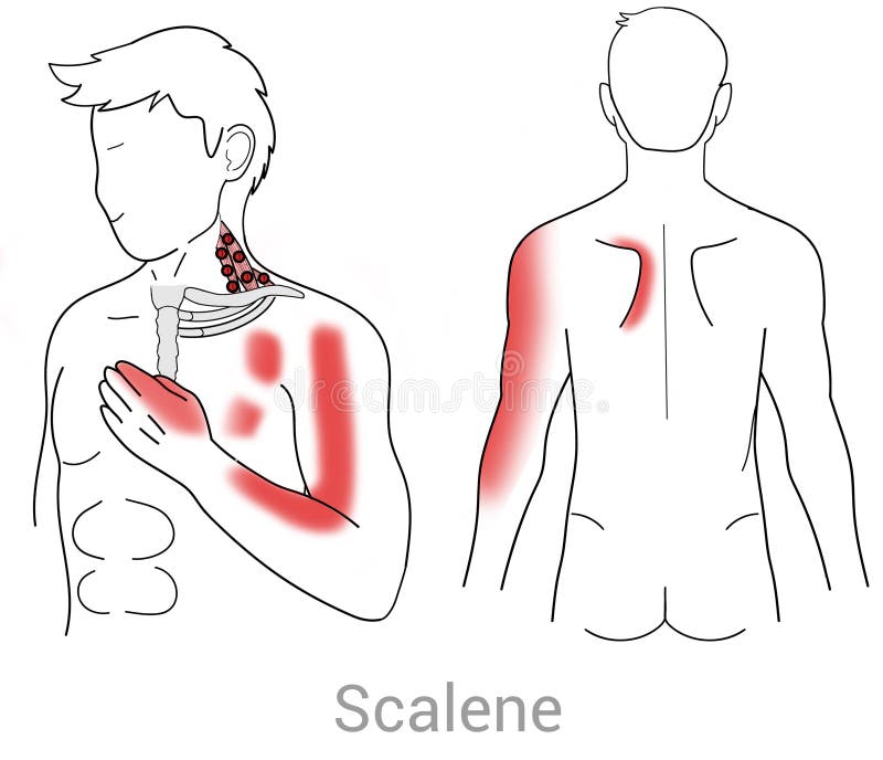Scalene Muscle Myofascial Trigger Points: Can Refer Pain To the Back ...