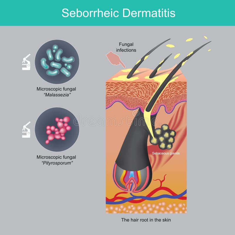 Scalp Fall of Sheets Problem Caused by Sebaceous Glands in Hair Roots ...