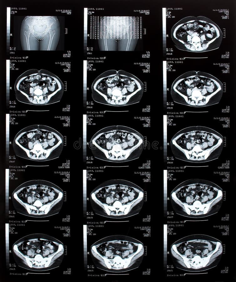 Scan of a Broken Pelvis stock image. Image of broken, pelvis - 4887675