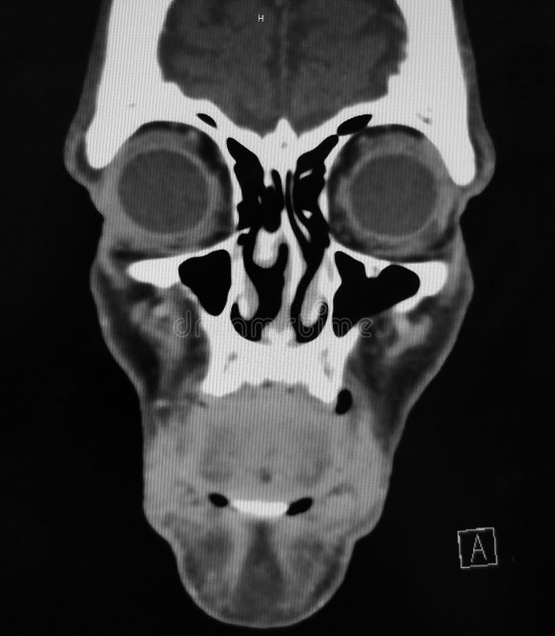 Scannage Coronal Ct Des Sinus Et Sinusite Maxillaire Droite Image stock ...