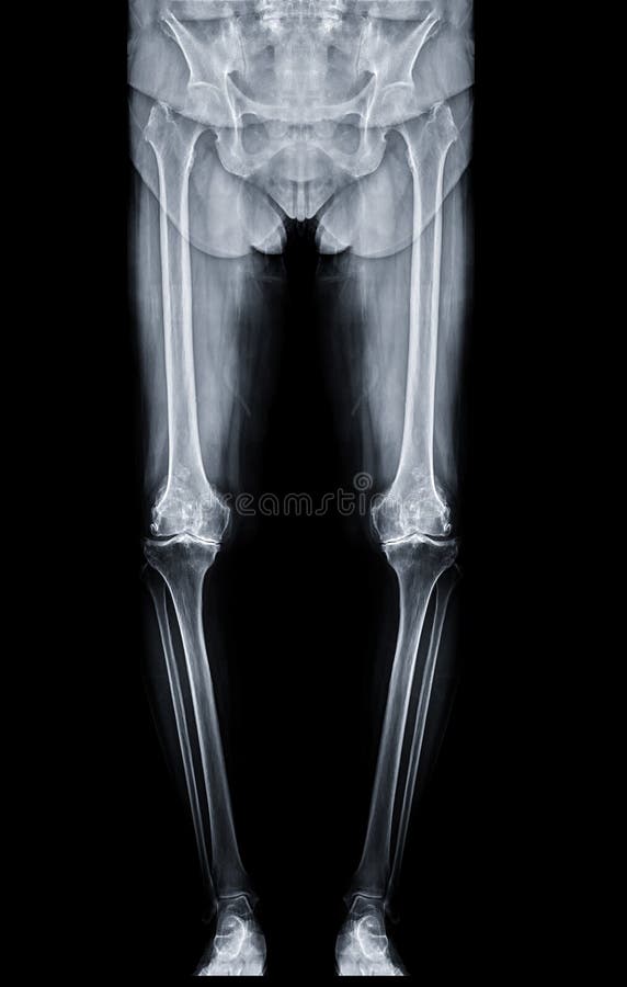 Scanogram is a Full-length Standing AP Radiograph of Both Lower ...
