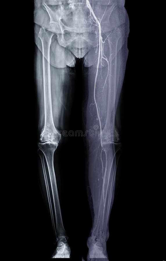 Scanogram Image Fusion with CTA Lower Extremities Stock Image - Image ...